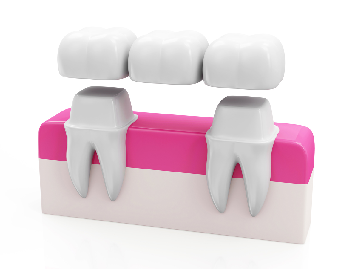 Dental bridges - Implantcenter dentistry UK