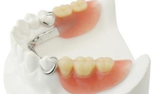 Denture, Prosthesis - Implantcenter dentistry UK